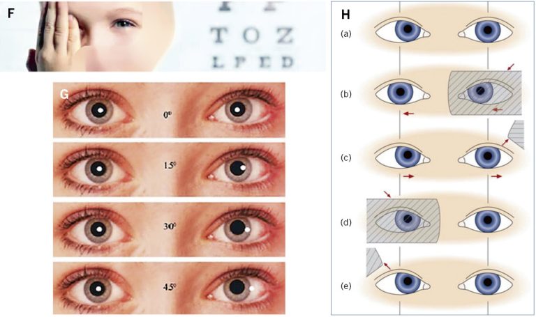 MIDRIASIS: DEFINICIÓN y TRATAMIENTOS EFECTIVOS en MADRID